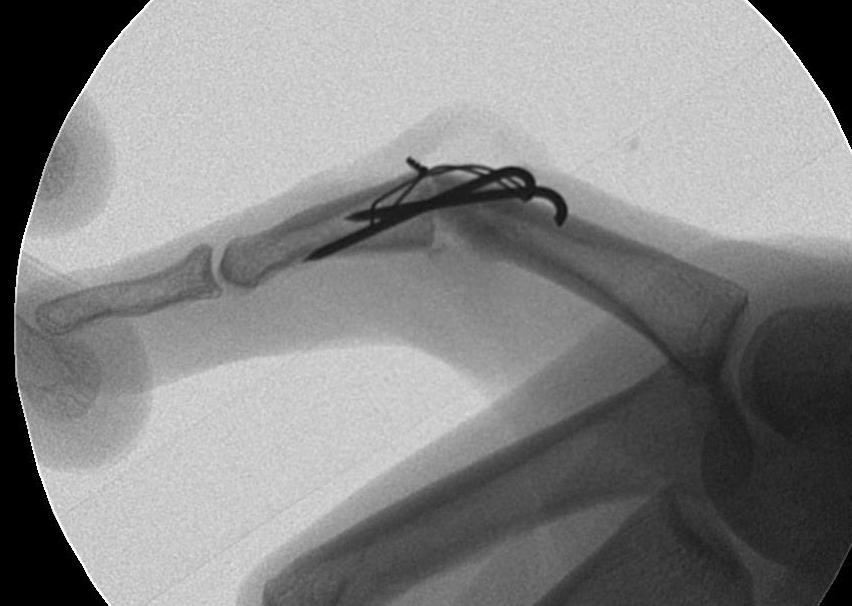 Finger Deformity- What happens late? | Congenital Hand and Arm ...