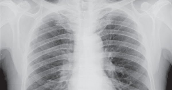 Study Medical Photos: Costochondral Calcification Seen On Chest X-Ray