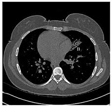 Situs Inversus Totalis