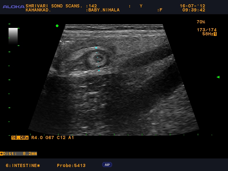 Shrivari Sono Scans: Ultrasonography for the diagnosis of appendicitis..