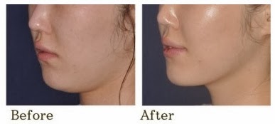 April31 Plastic Surgery Clinic: V-Line / Double Chin / Face Lift