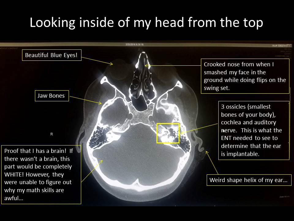 Hear My Voice, See My Words: Beginning my Cochlear Implant Journey