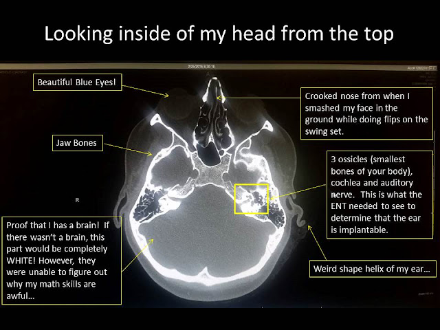 Hear My Voice, See My Words: Beginning my Cochlear Implant Journey