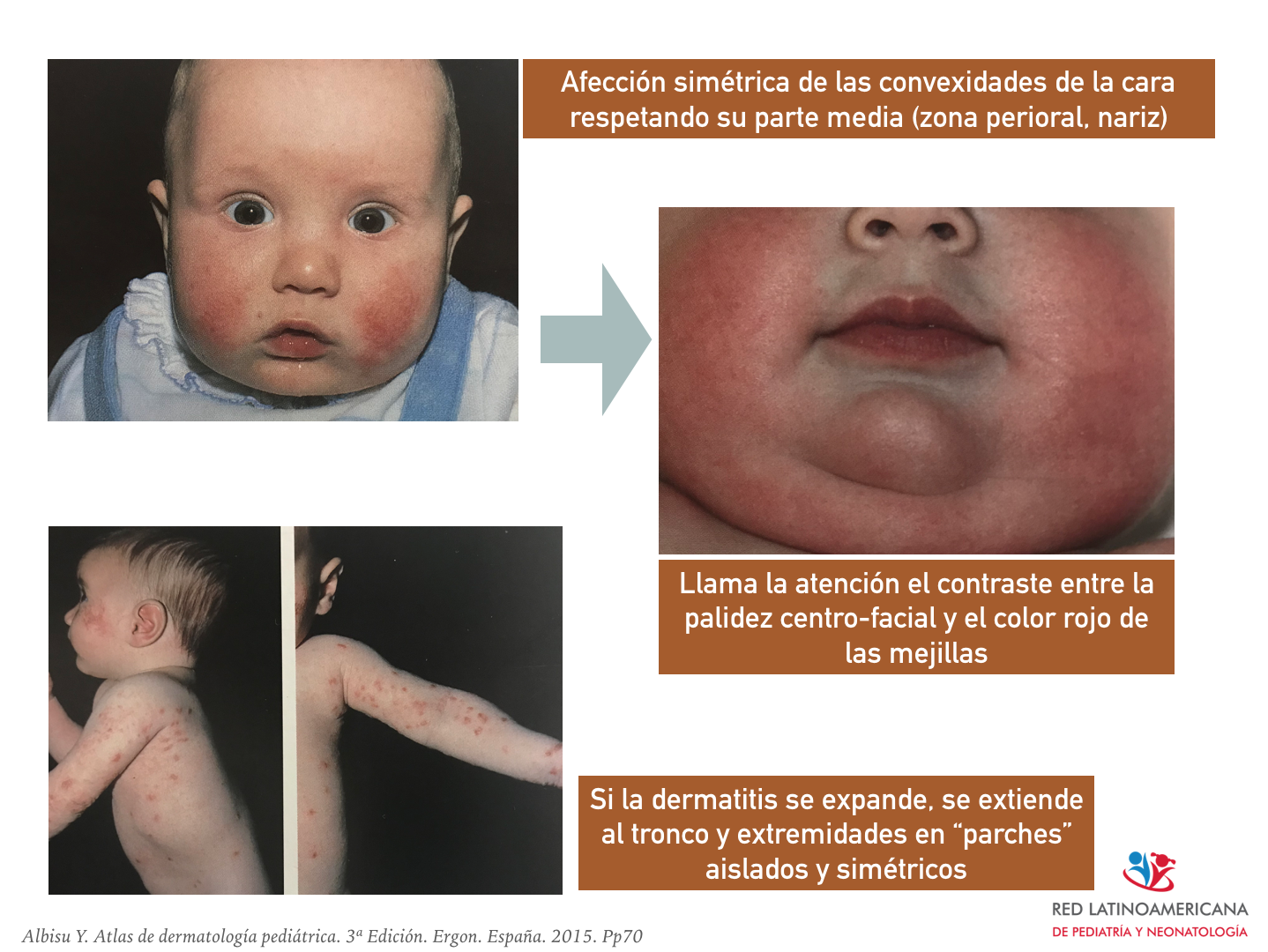 RED LATINOAMERICANA DE PEDIATRÍA Y NEONATOLOGÍA: [RESUMEN DE ...