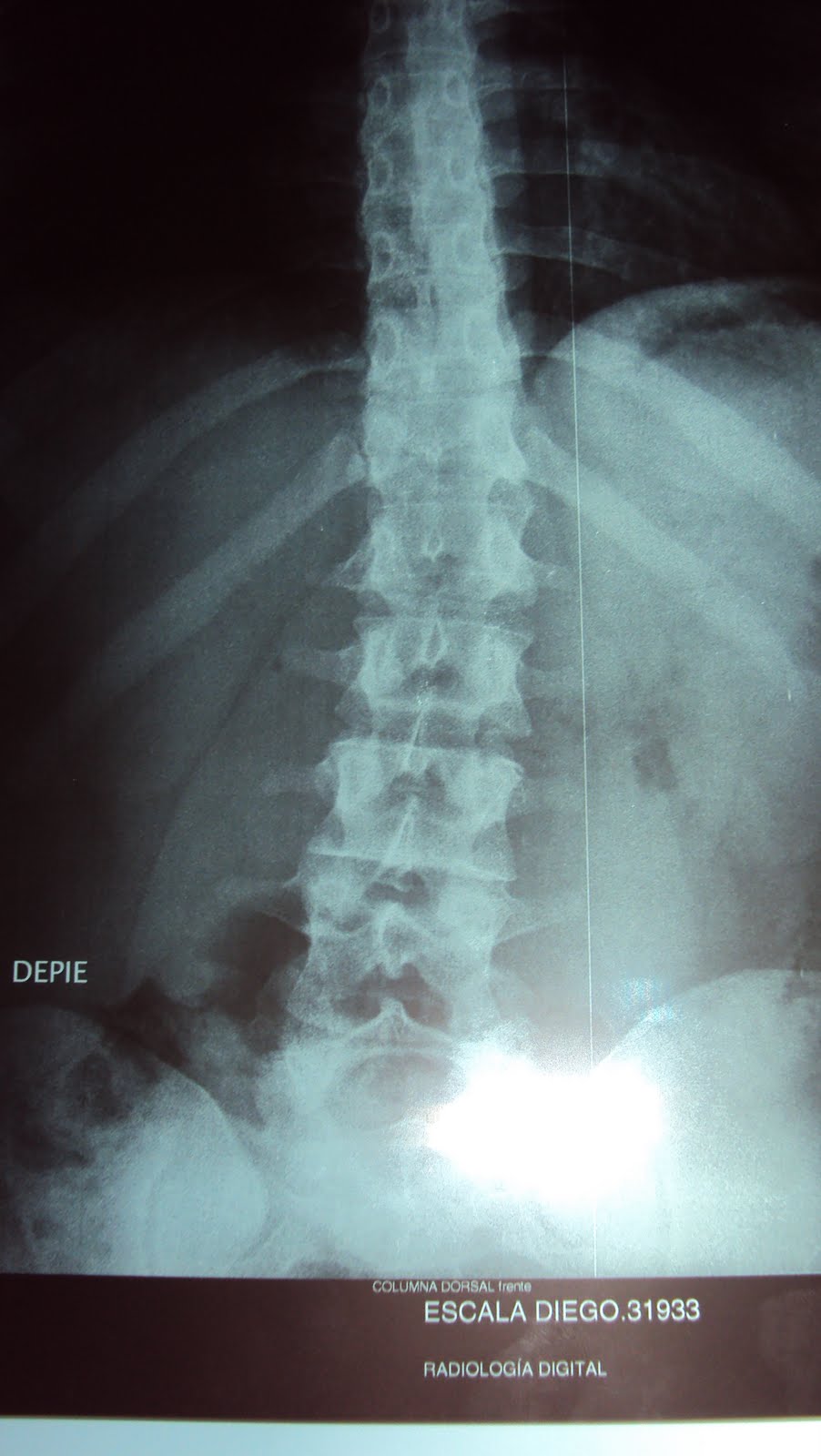escoliosis lumbar idiopática: Una opción de tratamiento no quirurgico