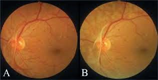 Medical Treatment Pictures-for Better Understanding: Retinal Laser ...