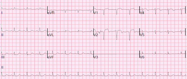 Dr. Smith's ECG Blog: What, besides large anterior STEMI, is so ominous ...