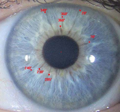 Modern & Multidimensional Iridology: Multiple Radial Furrows at ...