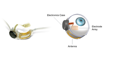 Bionic Eye, Argus II Retinal Prosthesis System, Gets Approval ...