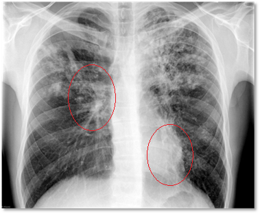 TUBERCULOSIS LATENTE Y LETAL: TUBERCULOSIS PULMONAR