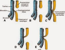 Medical Treatment Pictures-for Better Understanding: Esophageal Atresia ...