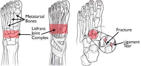 No More Foot Pain: I never heard of a Lis Franc injury