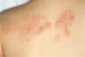 sikkahoder: mengenal berbagai bentuk kelainan pada kulit