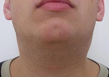 Prezentari Medicale: Mononucleoza infectioasa (MNI)