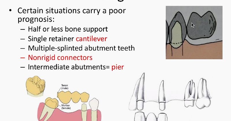 PROSTHODONTICS: General Considerations - Odonto-Tv