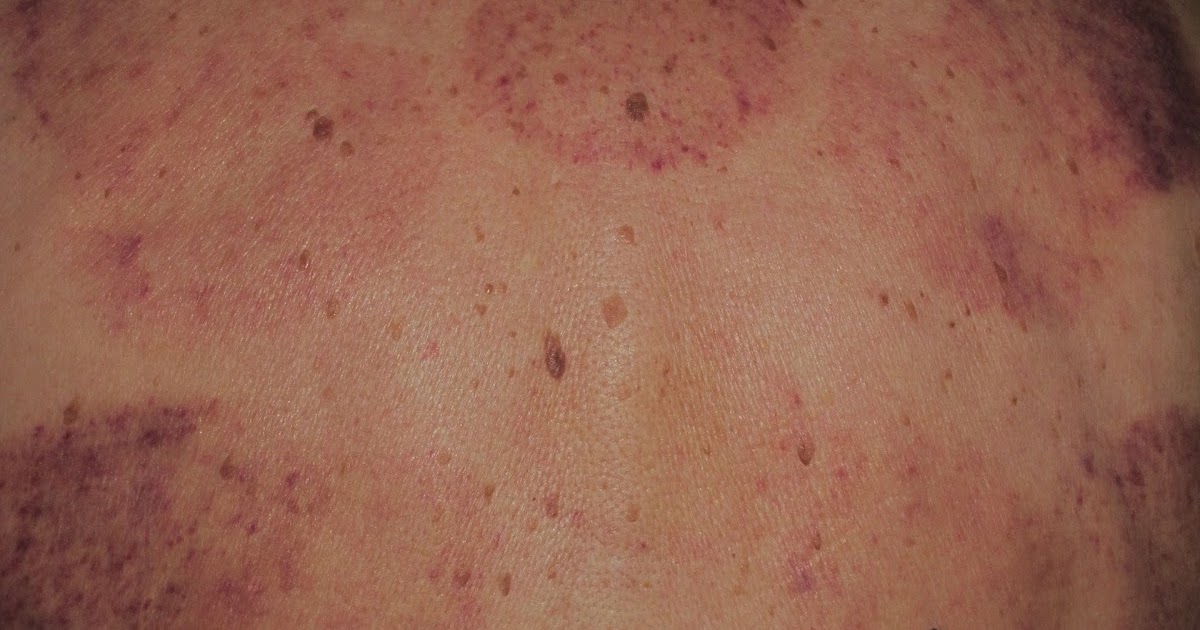 Dermapixel: Círculos púrpura