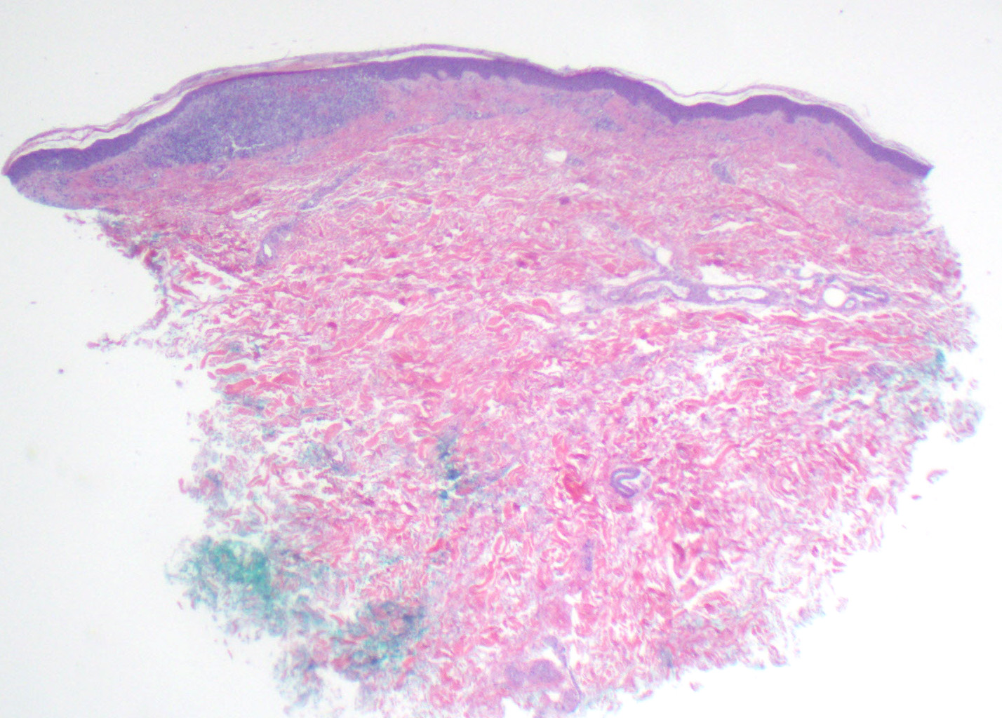 VIRTUAL GRAND ROUNDS IN DERMATOLOGY 2.0: Mycosis Fungoides