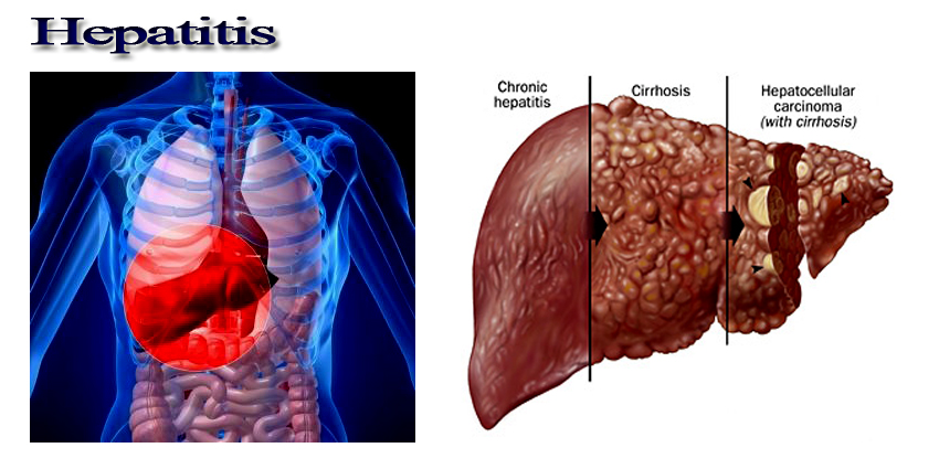 Spiritual and Physical Health Tips: All about Hepatitis Disease