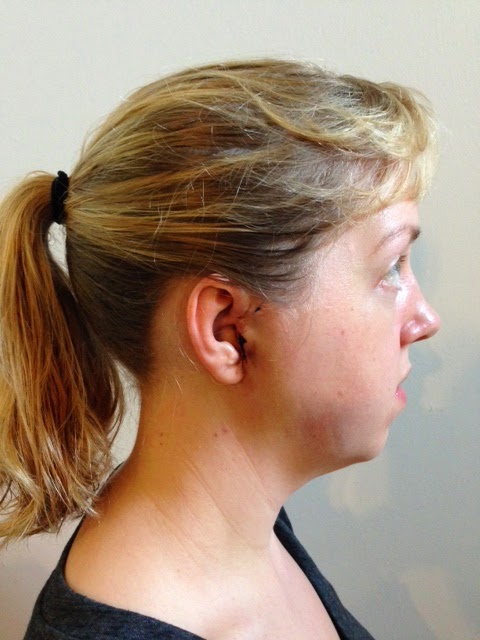 Katie's Orthognathic Surgery: Post TMJ Day 3