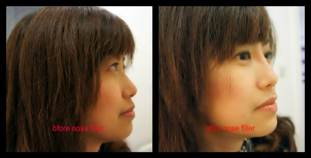 GOOD LUCK LADIES: How to have pointed nose or smaller nose
