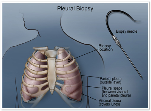 Pleural Biopsy - Soraya Detlef Blog