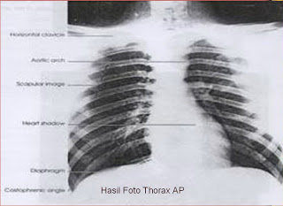 Radiology Squad: Teknik Pemeriksaan Radiografi Thorax