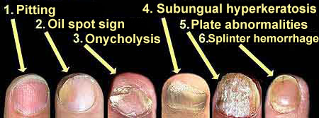 Nail pitting: Nail pitting causes