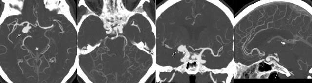 Aneurysm of Persistent Trigeminal Artery