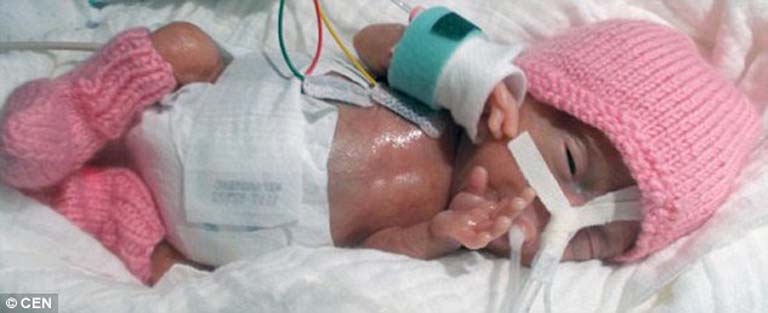Meet the world’s tiniest baby! - O.A.P