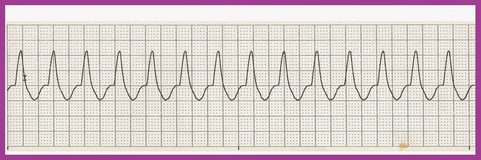 Tachycardia, ventricular; Ventricular Tachycardia
