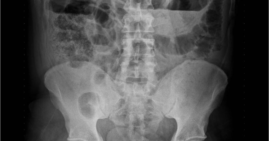 MEDICINA: INTERPRETACIÓN DE LAS RADIOGRAFÍAS DE ABDOMEN EN URGENCIAS