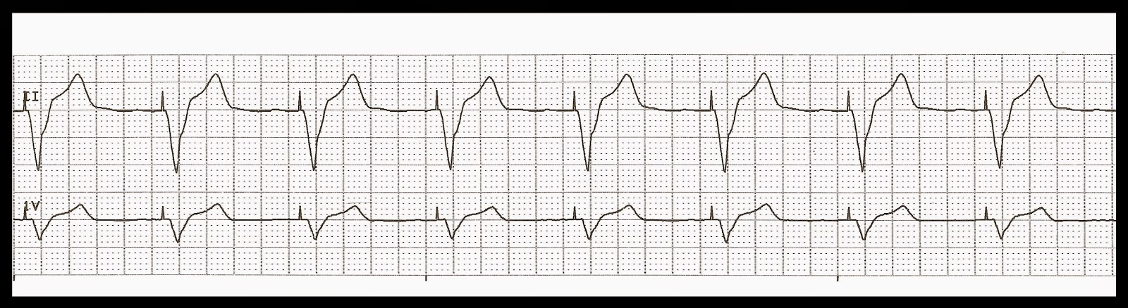 Practice EKG Strips 374