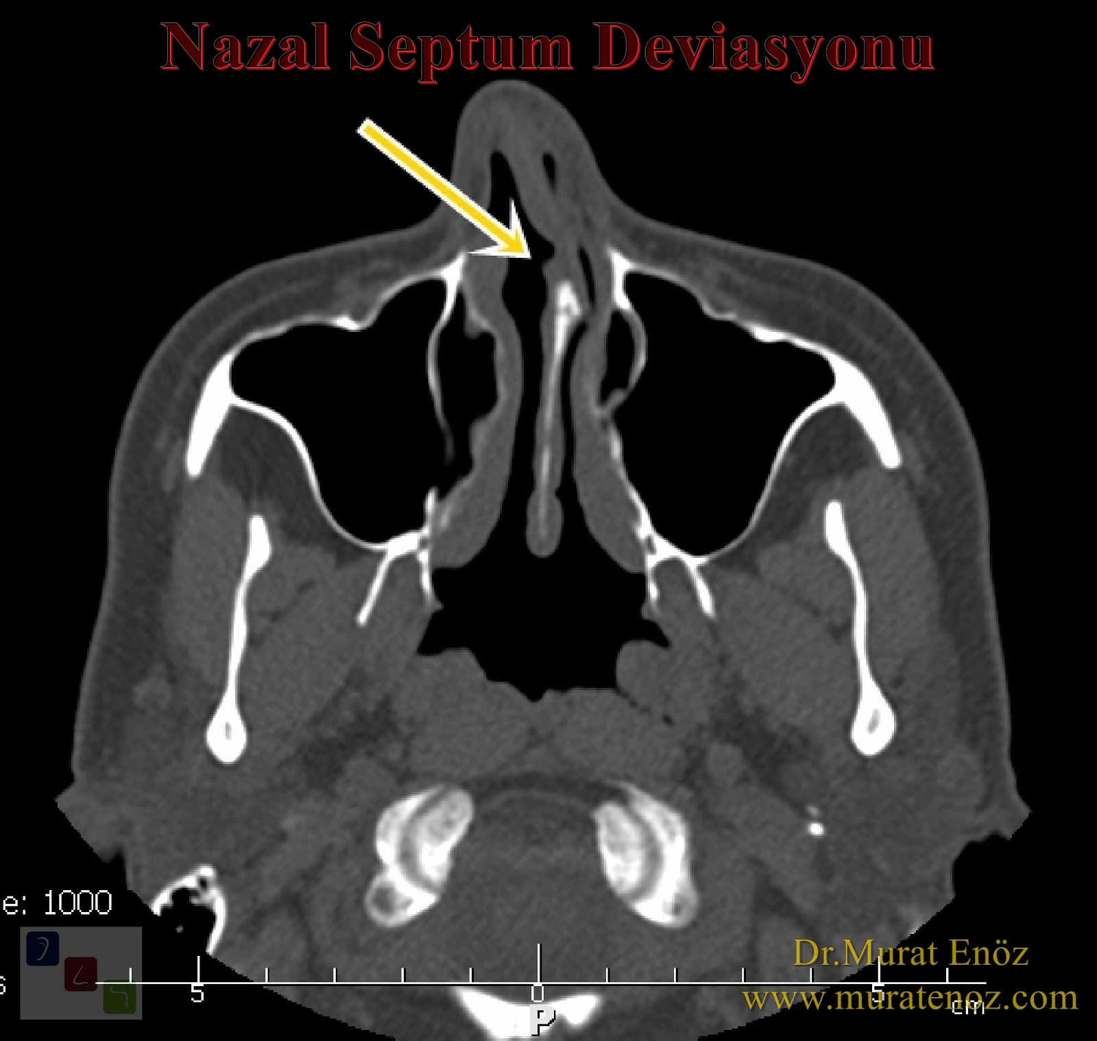 Nasal Septum Deviation Is More Frequently Seen In Infants Who Born With ...