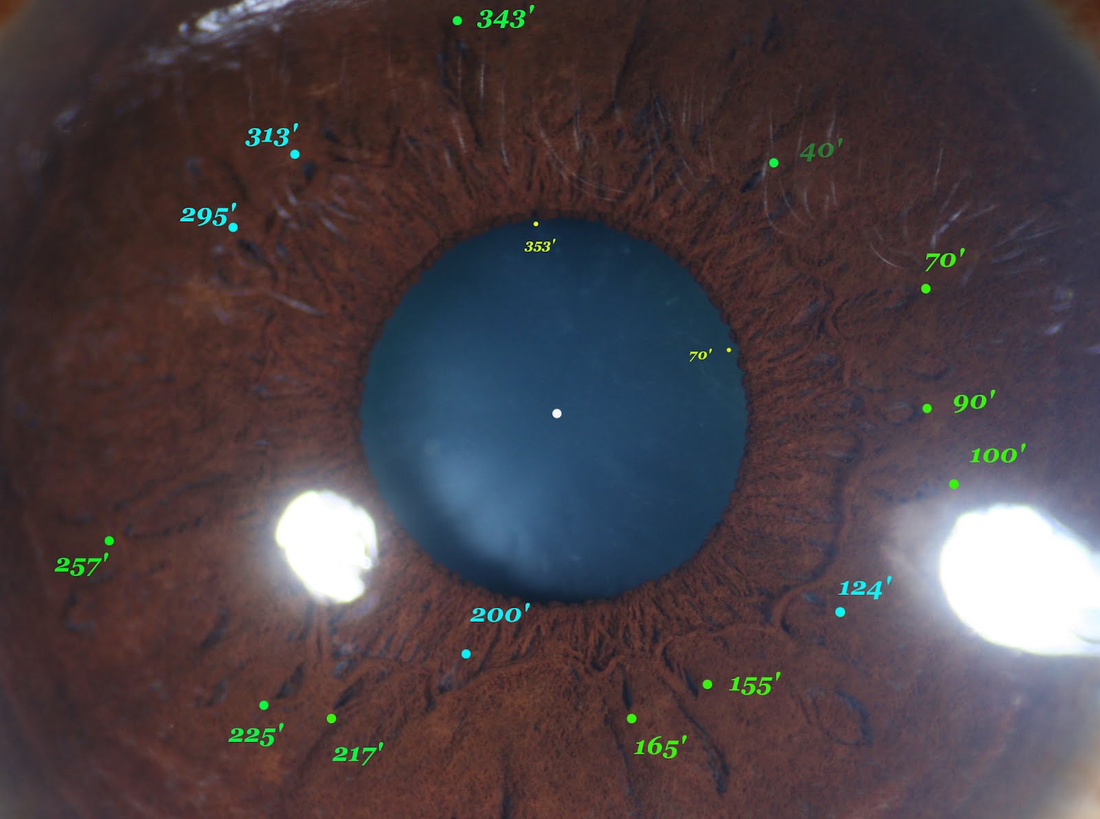 Modern & Multidimensional Iridology: Crypts & Closed Lacunae attached ...