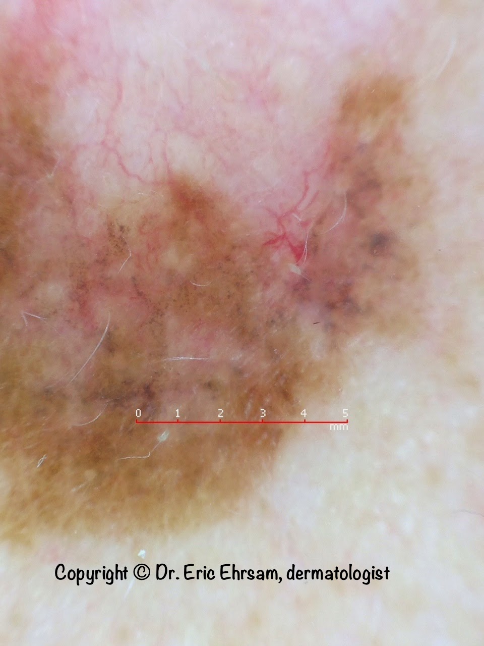 dermoscopy: Regression