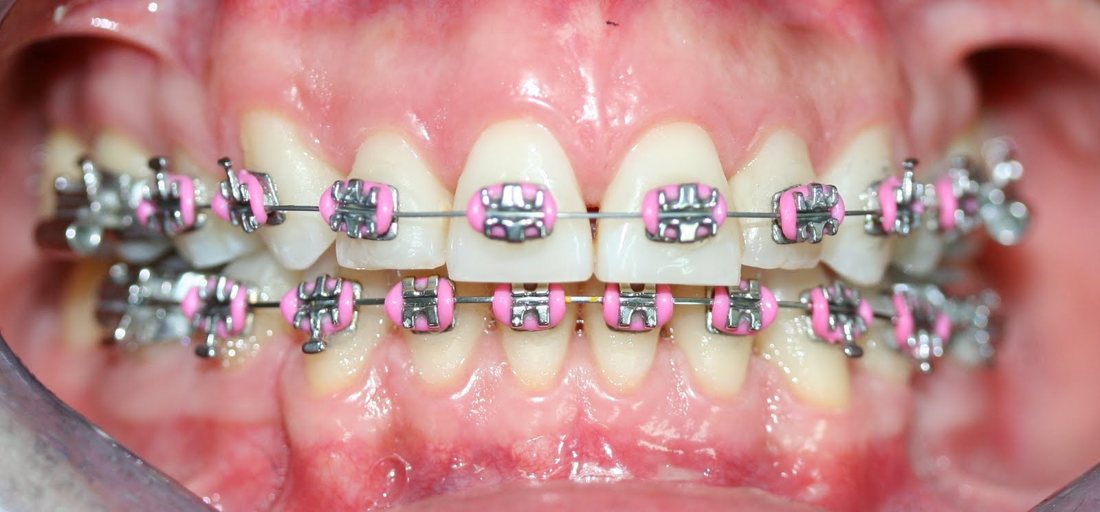 TRATAMIENTOS DENTALES: ¿CUÁNDO DEBEN COLOCARSE LOS BRACKETS?