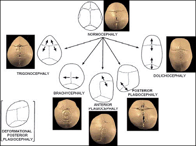 Craniossinostoses; Acrocefalia; Oxicefalia; Craniossinostose