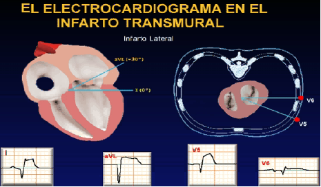 Electrocardiograma infarto transmural lateral