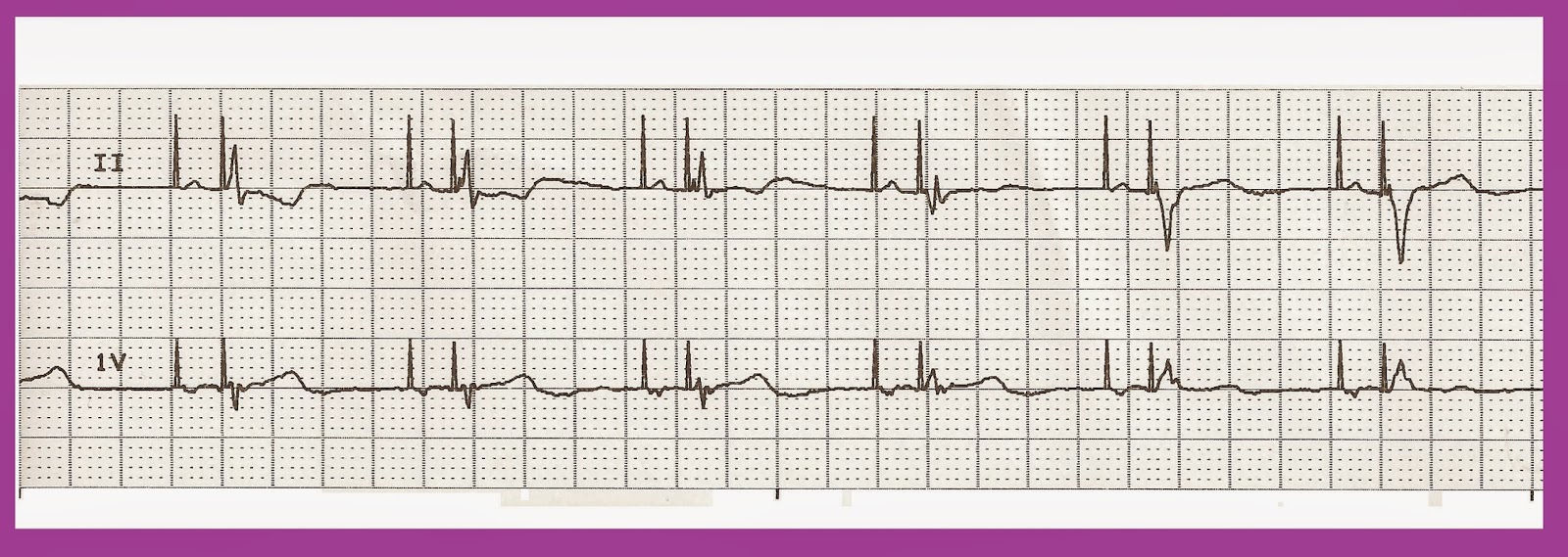 EKG Rhythm Strip Quiz 186
