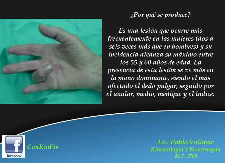 Consultorio Privado de Kinesiología y Fisioterapia: Dedos en Gatillo o ...