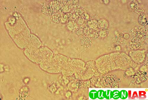 Atlas of Casts in urine | Free Medical Atlas