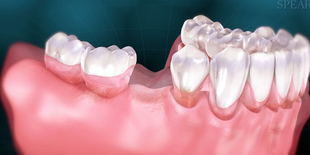 Extraccion del primer molar permanente como una alternativa en el ...