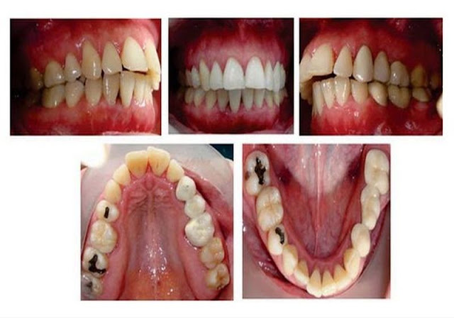 PDF: Corrección de Clase II División 1 con extracciones de segundos ...