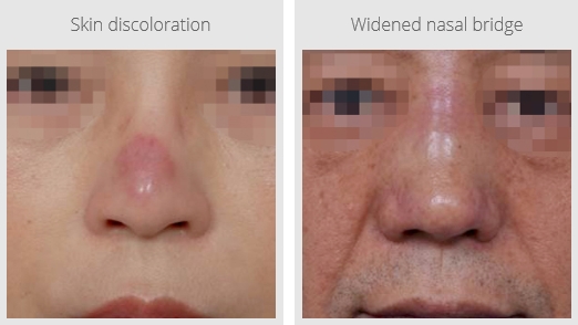 Best nose job clinic in Korea: Types of nose filler side-effect