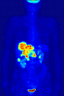 Fluorine-18, ^18F: Fluorine 18 use in Nuclear Medicine