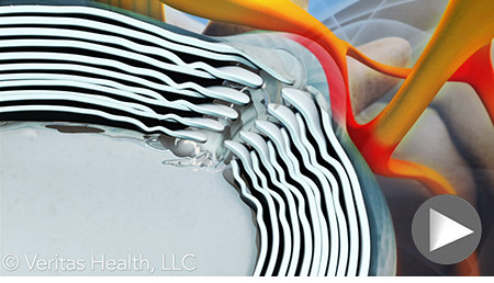 What's a Herniated Disc, Pinched Nerve, Bulging Disc...? ~ Middle Back Pain