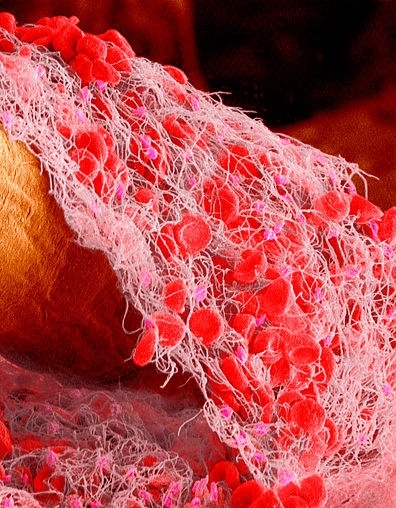 Medical and Health Science: Blood Clot-under Microscope