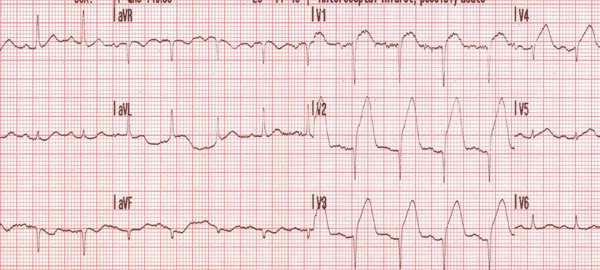 ECGs for EMS: Identification and Localization of STEMI: ANTERIOR WALL
