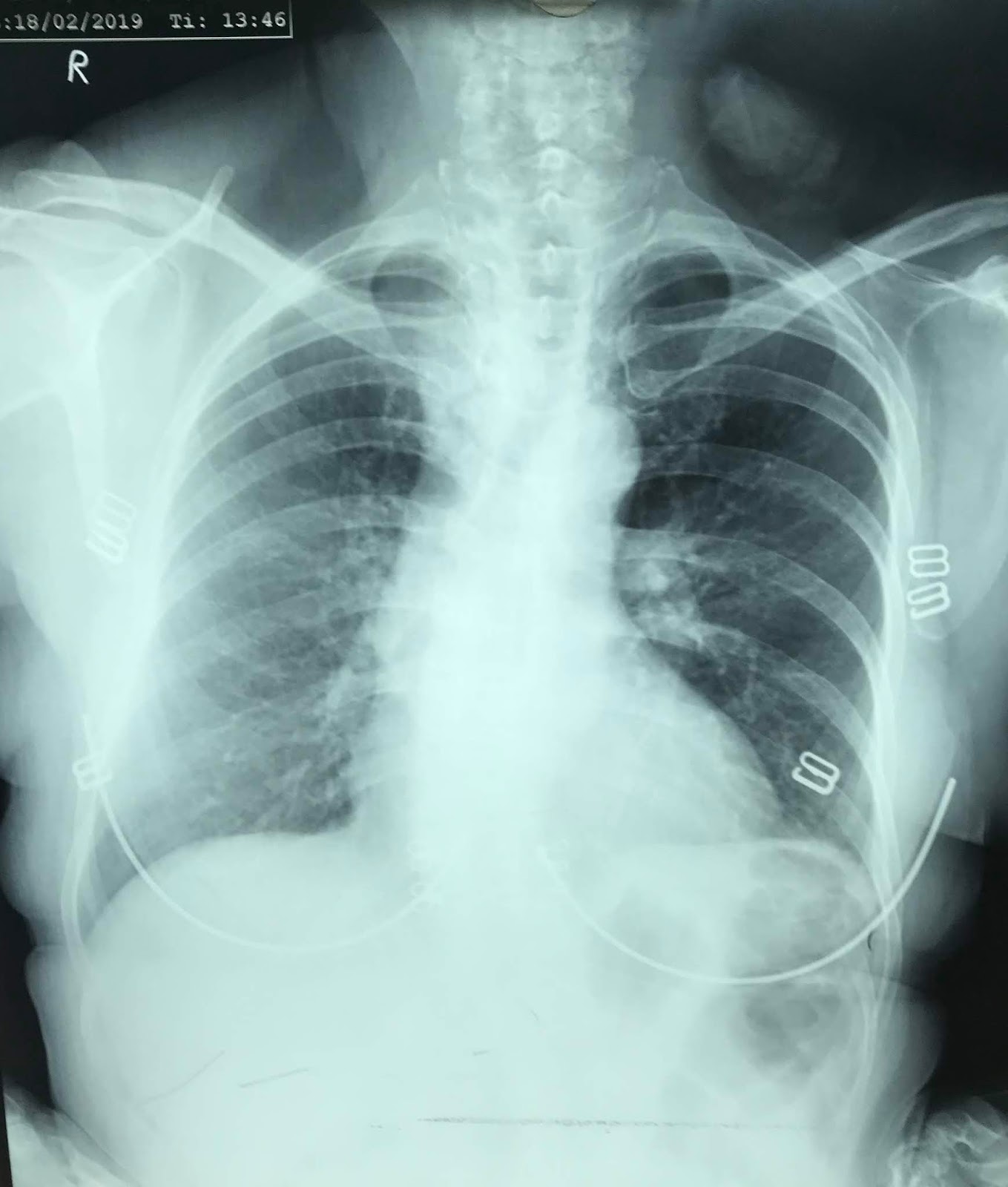 VIETNAMESE MEDIC ULTRASOUND: CASE 538: SUBMERGED MEDIASTINUM GOITER ...