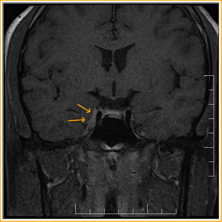 Tolosa-Hunt Syndrome-MRI - Sumer's Radiology Blog